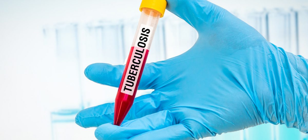 Care tulpini de tuberculoză sunt cele mai infecțioase? - 360medical.ro